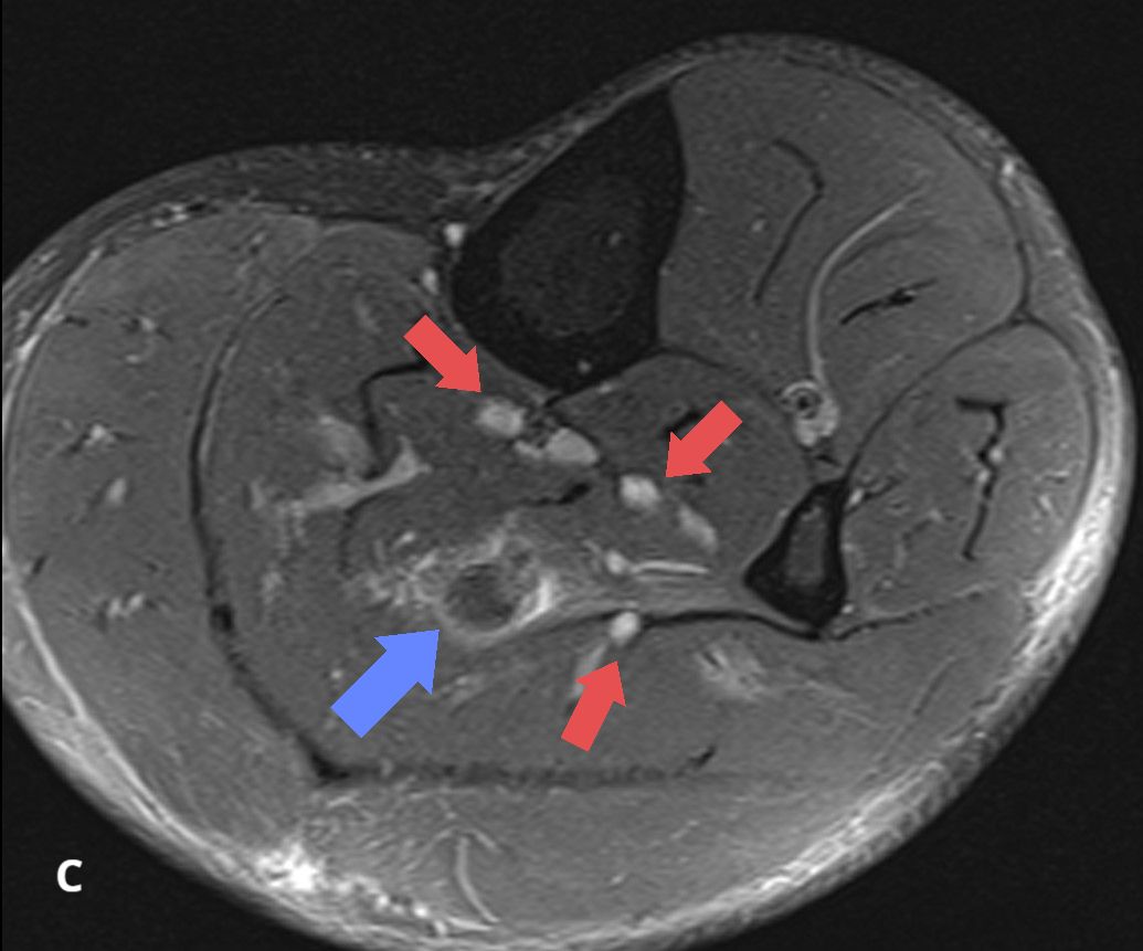 Case Study DVT on MRI Knee - Sydney Imaging Specialists