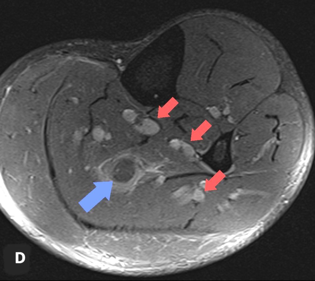 Case Study DVT on MRI Knee - Sydney Imaging Specialists